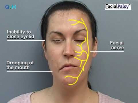 Understanding Facial Palsy | ERGSY